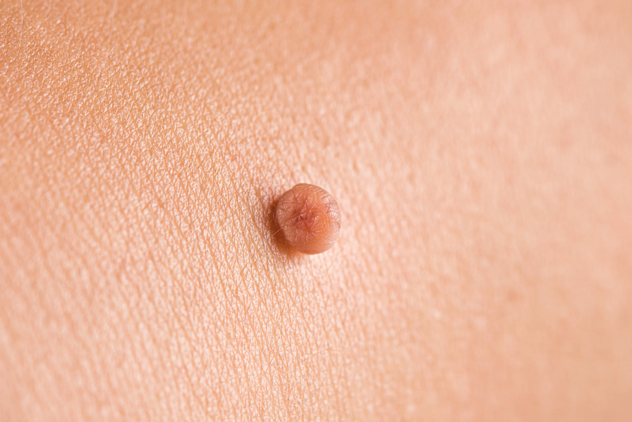 Skin Tags / DPN - Aesthetic Care Center Aesthetic Care Center